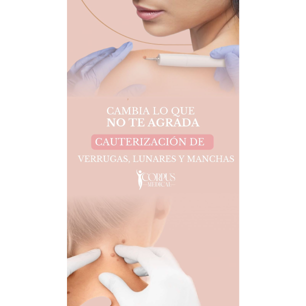 cauterización de verrugas - null